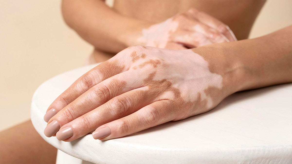 Vitíligo: seis cosas que debes saber sobre él - UnoTV