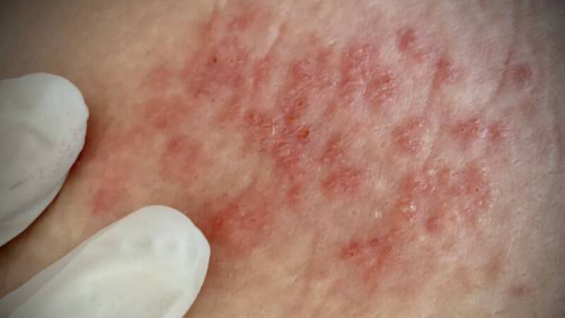 Herpes zóster, qué es y dónde aplicarse la vacuna contra la culebrilla