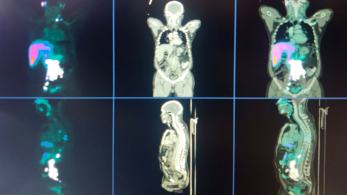 PET-CT: ¿cómo es el estudio que ayuda a diagnosticar el cáncer y otras enfermedades? - UnoTV