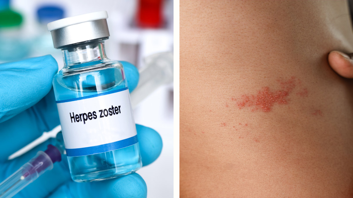 Herpes zóster, qué es y dónde aplicarse la vacuna contra la culebrilla