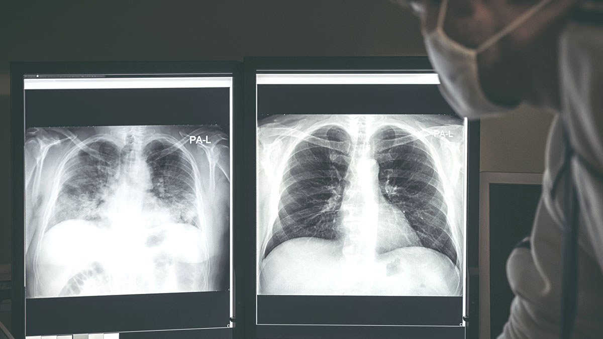 Pulmón blanco, ¿qué es esta señal relacionada con la neumonía? - UnoTV