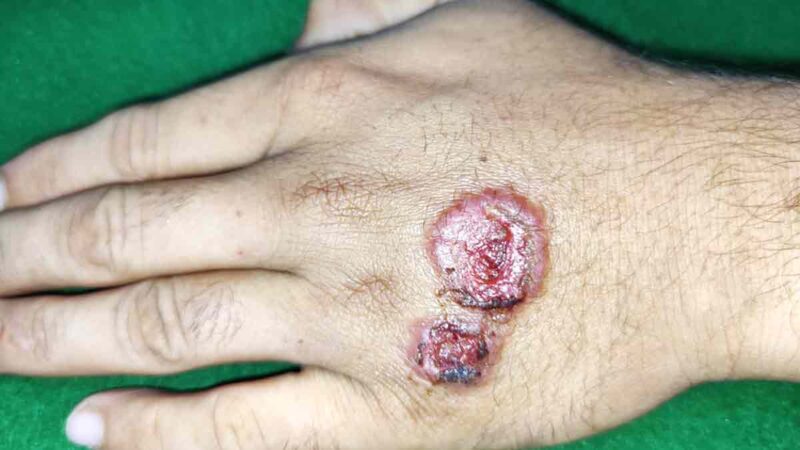 Leishmaniasis, ¿qué es esta enfermedad que va a la alza en México? - UnoTV