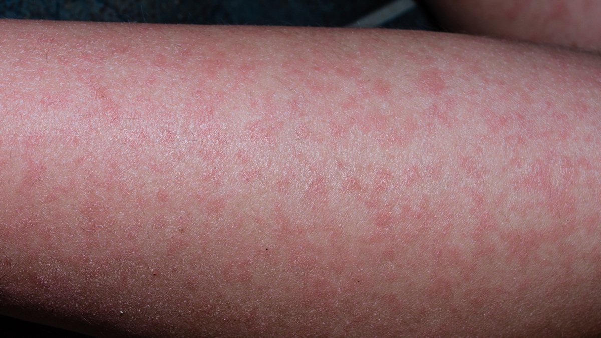 Suben casos de parvovirus en niños de EU, ve síntomas - UnoTV