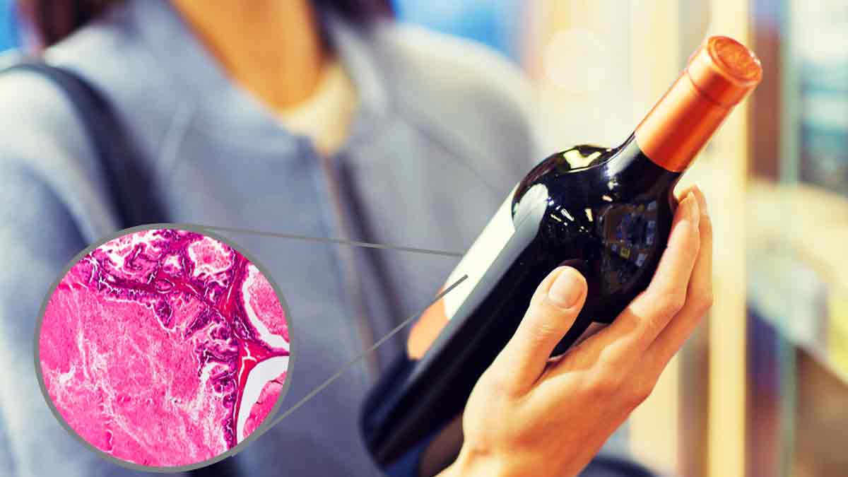 Alto consumo de alcohol podría aumentar el riesgo de padecer seis tipos ...