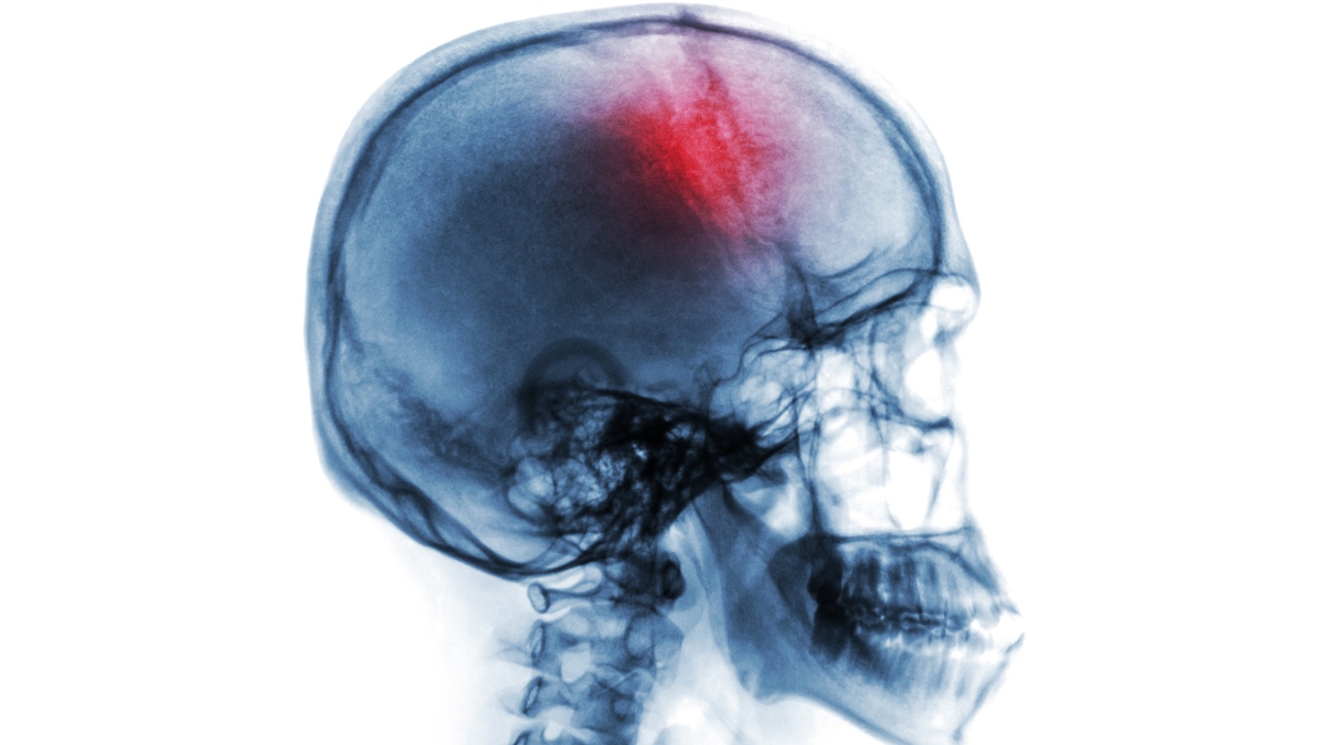 ¿Qué es un traumatismo craneoencefálico? - UnoTV