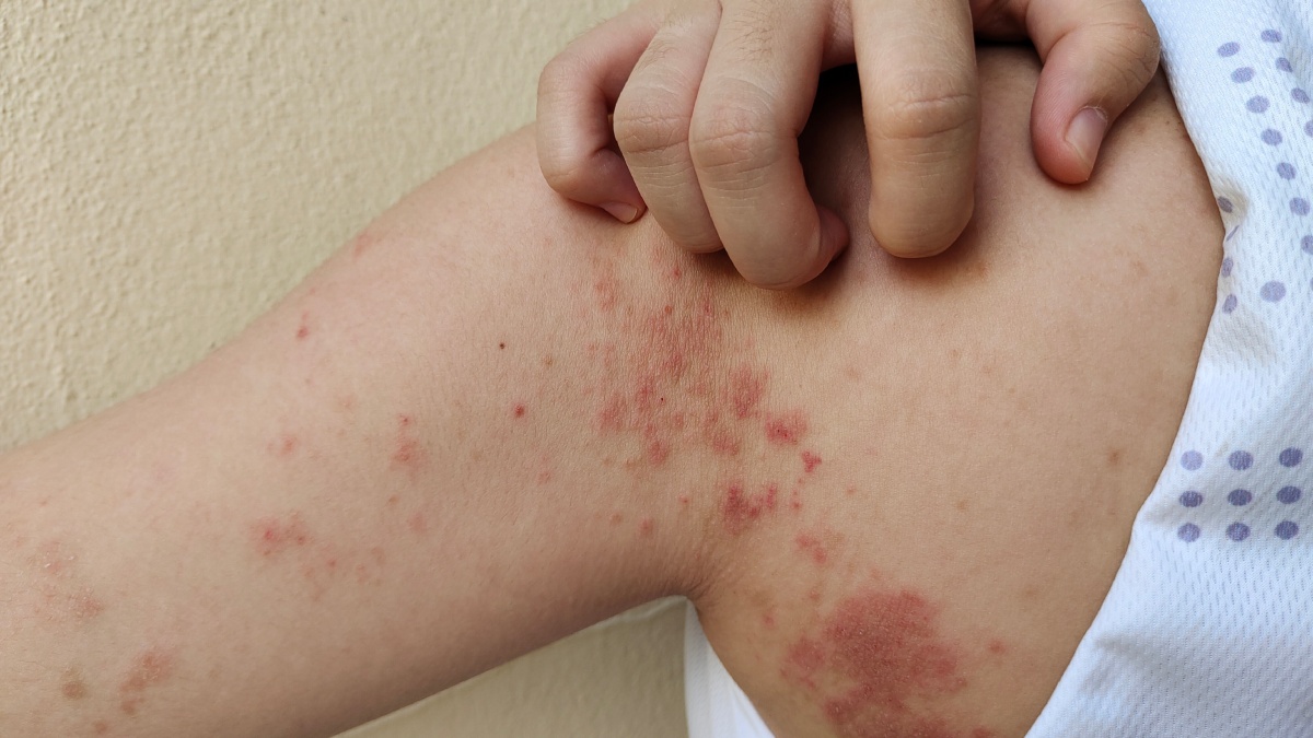 ¿Qué tan común es la lepra en México, y dónde hay más casos? - UnoTV