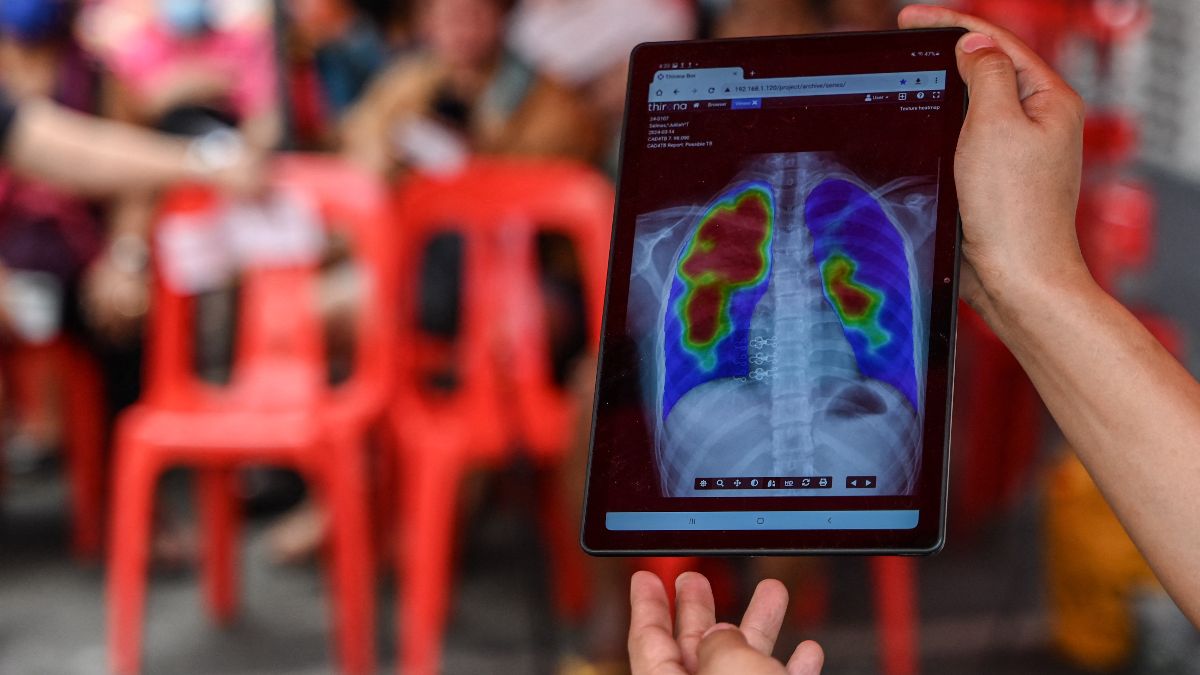 Casos de tuberculosis han aumentado en la región, alerta OPS: ve ...